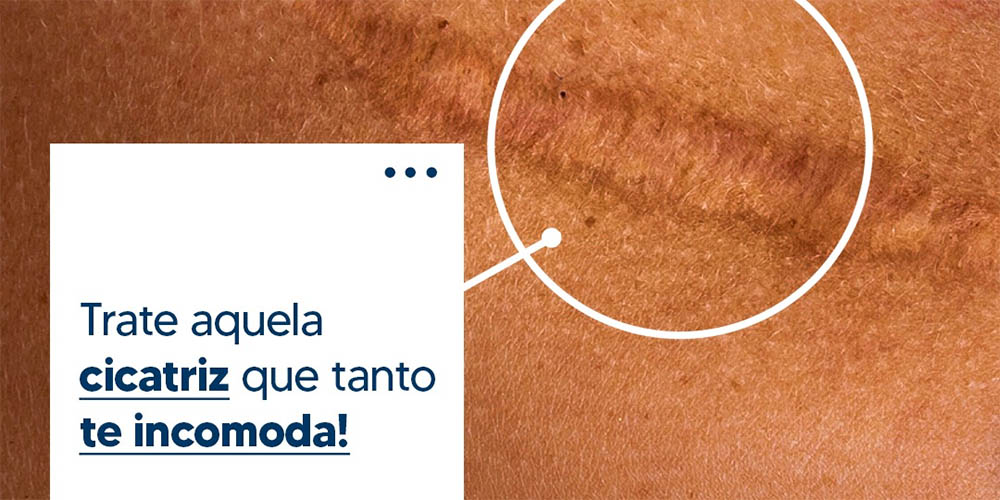 Trate aquela cicatriz que tanto te incomoda - Dr. Veimar Roberto Zortéa ...